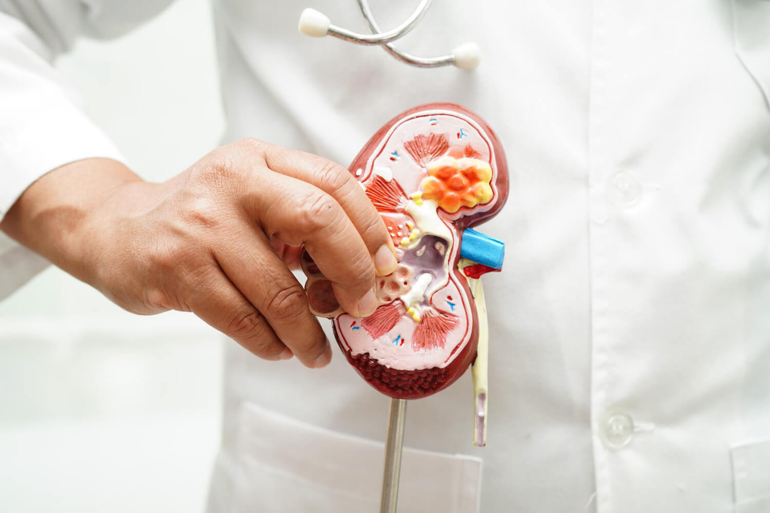 Managing Kidney Stone Pain with Relief Strategies