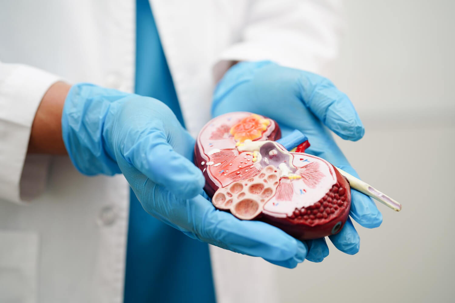 Discovering Kidney Stones: Nephrolithiasis vs. Urolithiasis