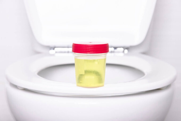Urine Test for UTI: How It Works and Its Role in Diagnosis