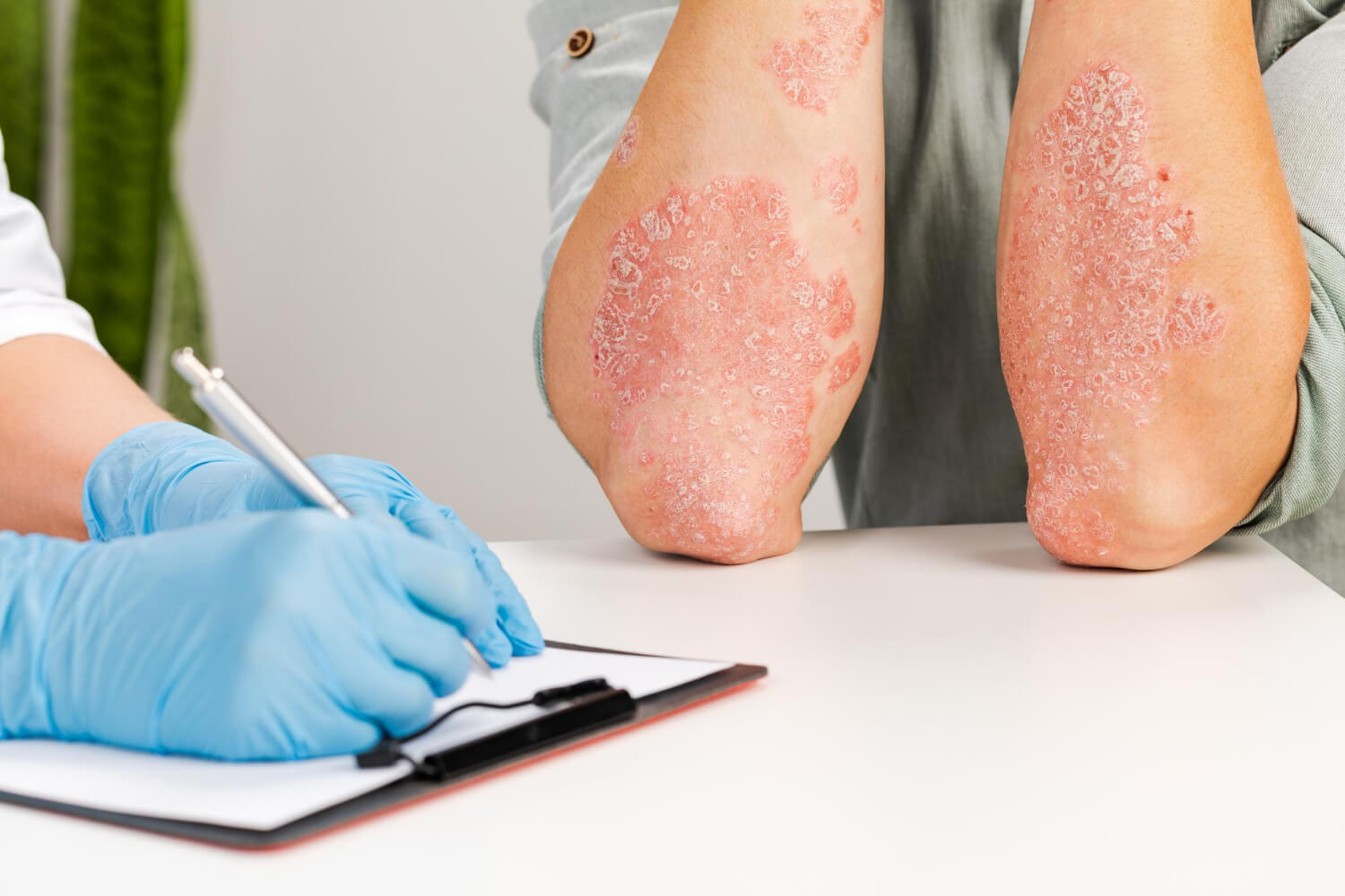 Expert Guide: Atopic Dermatitis Symptoms & Treatments