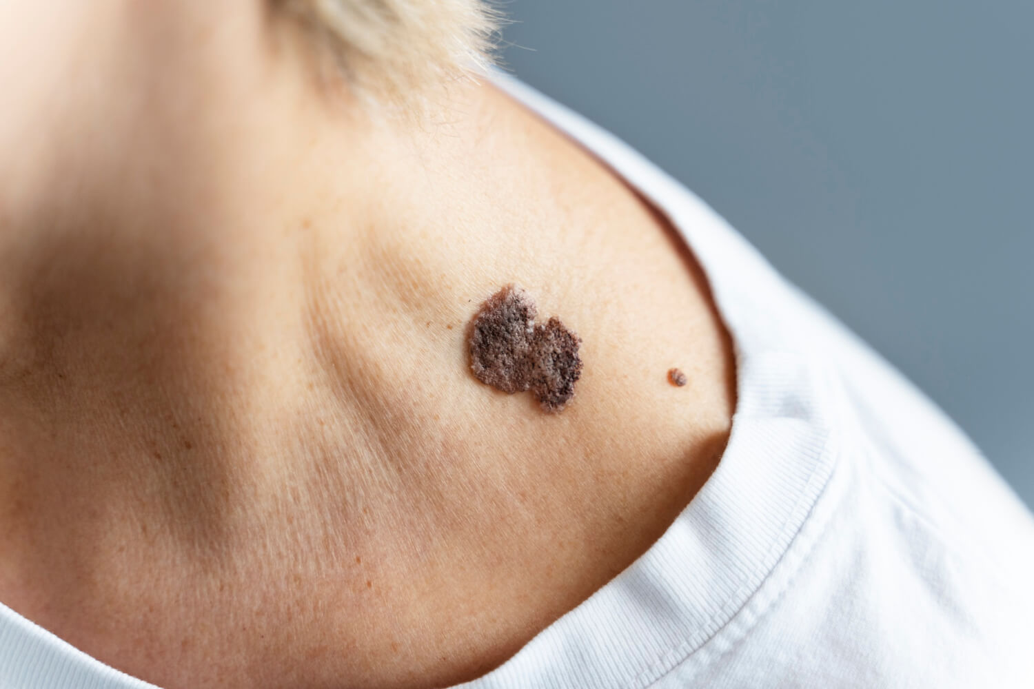 Melanoma 101: Symptoms, Causes, Treatment Overview