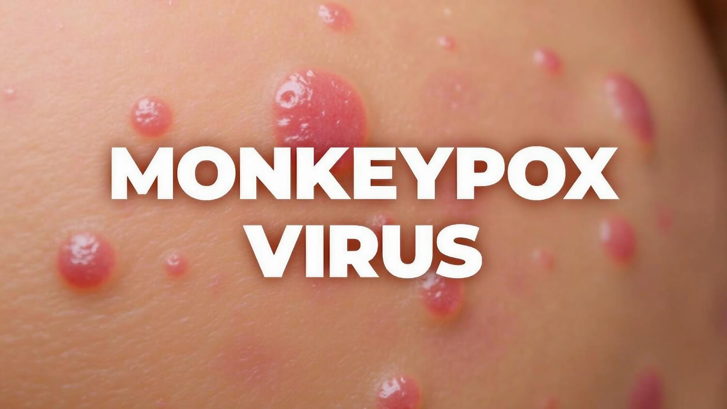 Decoding Mpox Spread: Key Insights for Filipinos