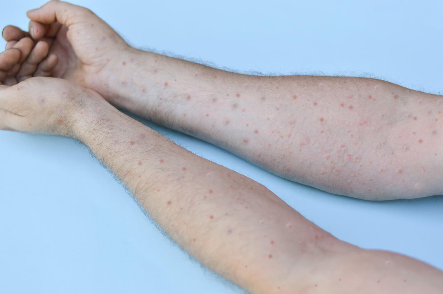 Effective Mpox Precautions for Health and Safety